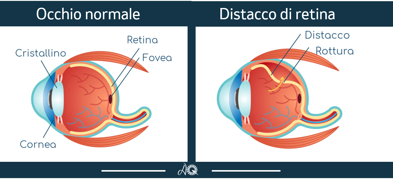 Distacco di Retina – Dott. Andrea Quercia